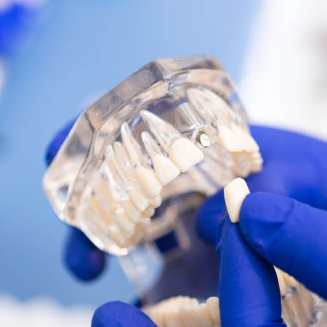 Denver Implants | Best Dental Implants in Denver